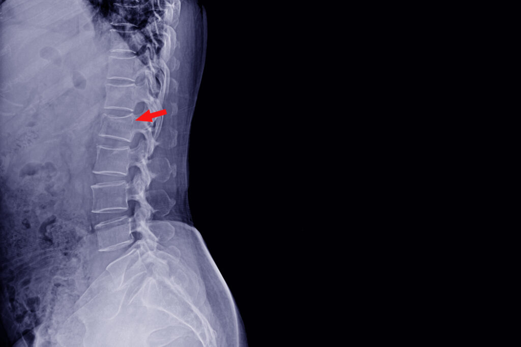 Minimally invasive fixation for Spinal fractures – Dr Gaurav M